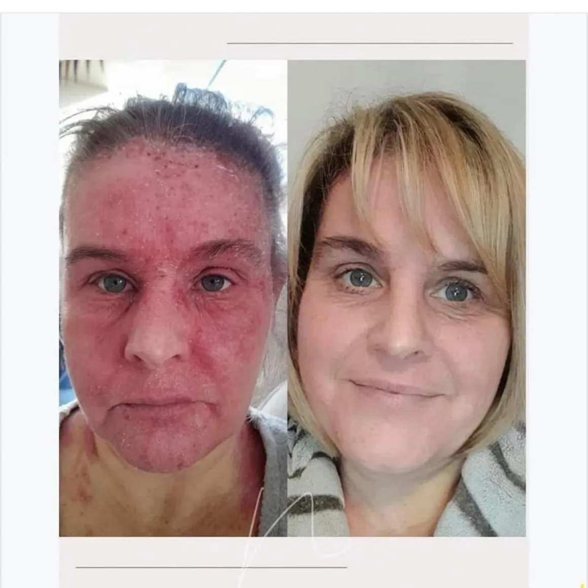 Laser Light for Acne | CAP Treatment | Laser Light Skin Clinic