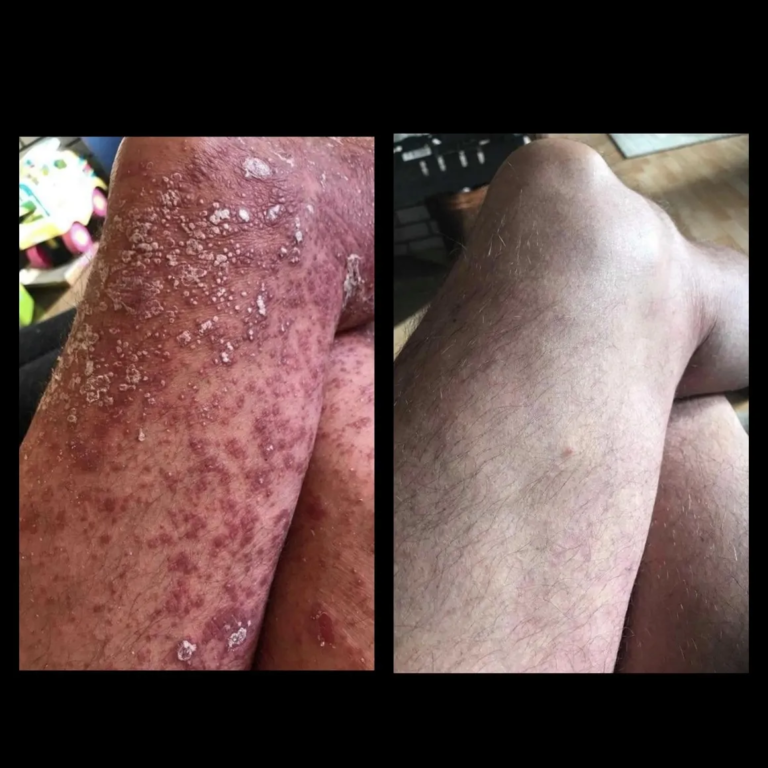 Laser Light for Acne | CAP Treatment | Laser Light Skin Clinic