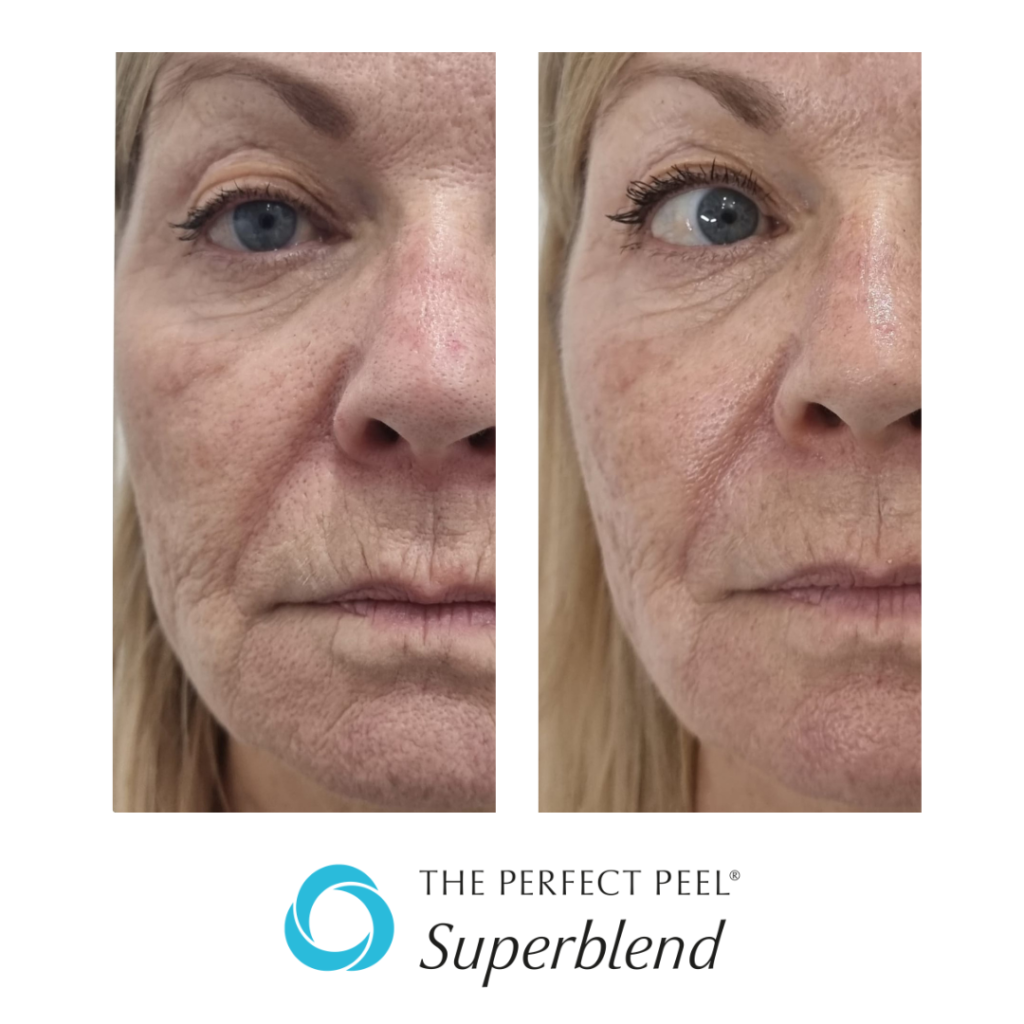 Laser Light | Perfect Peel | Laser Light Skin Clinic