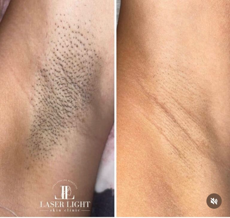 Laser Light Skin Clinic - Lip Fillers, Botox, Lemon Bottle, Lumi Eyes ...